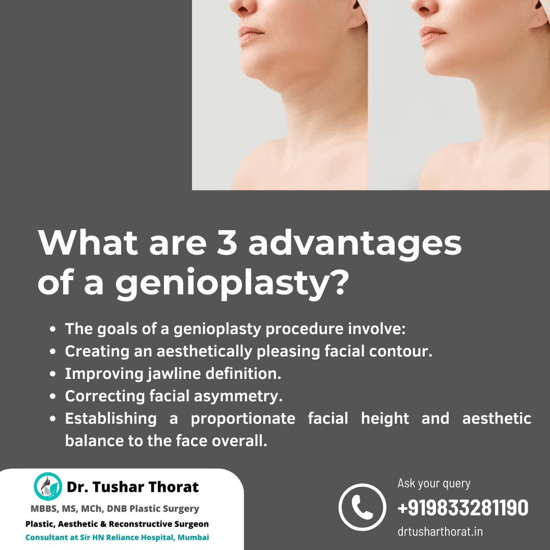 What is Genioplasty